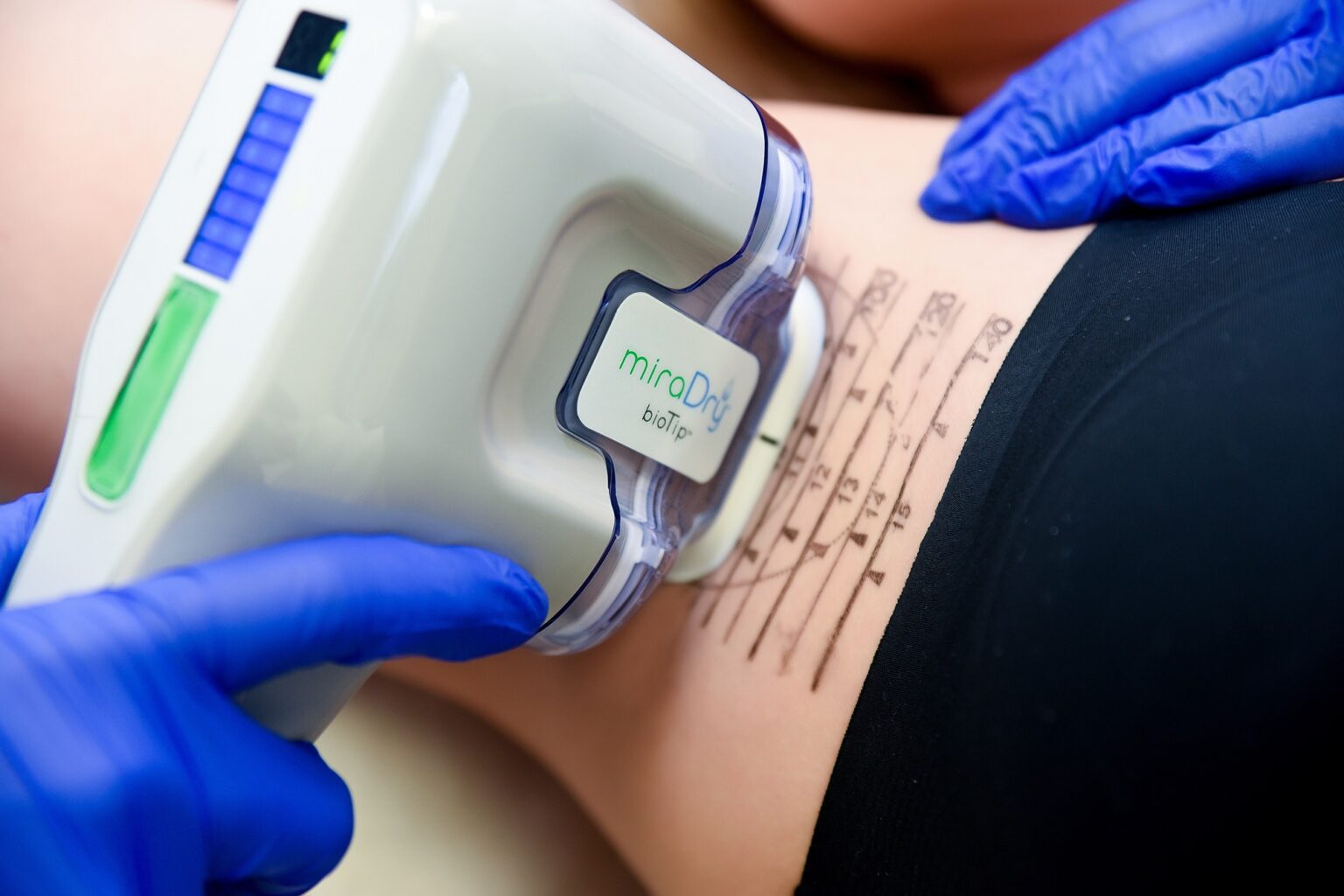 6 Benefits of miraDry Treatment - Jaxtr